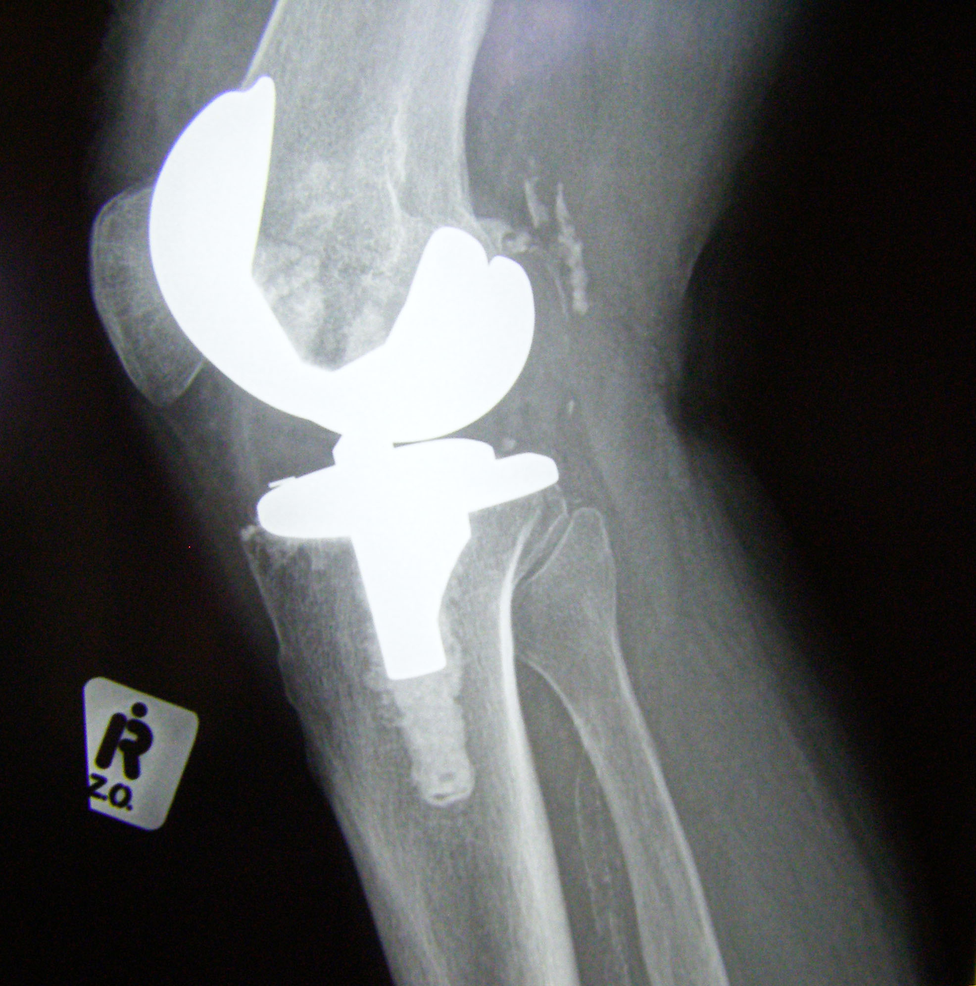 Meniskus a jeho příznaky | Plné zdraví