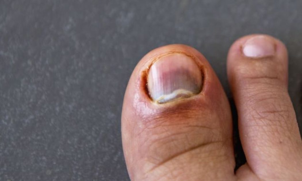 Trápí vás zarostlý nehet? Použijte ocet nebo dentální nit